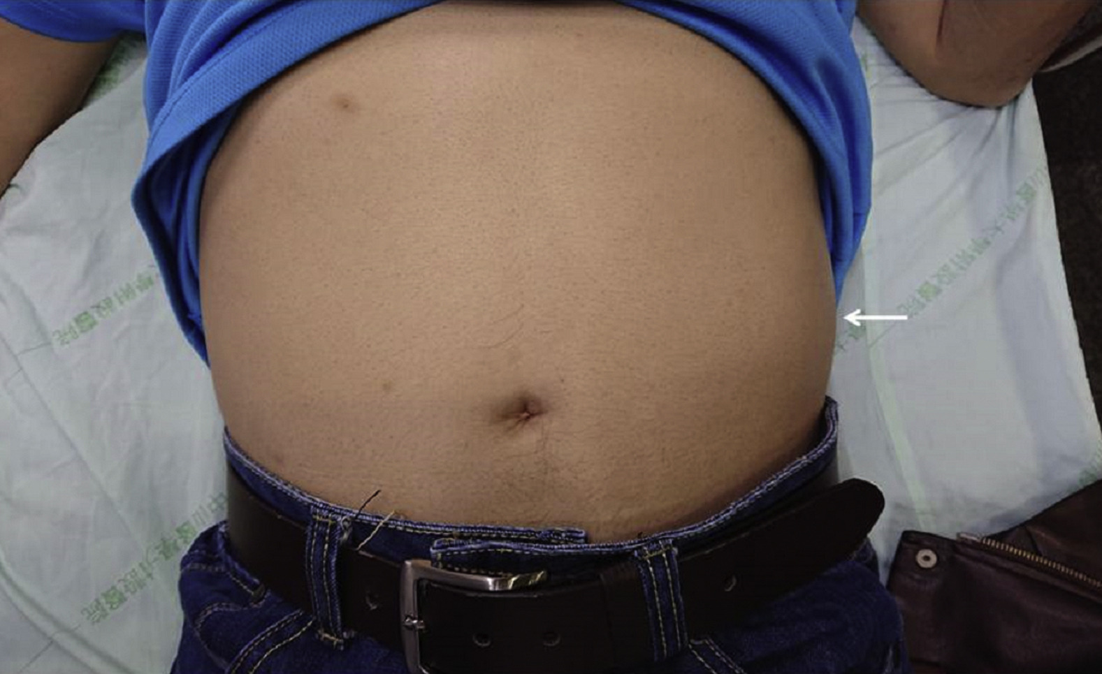 Kai pilvo pūtimas kelia diskomfortą - Sindromas